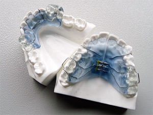 Types of Appliances - Orthodontist Nelson BC | Bibby Orthodontics